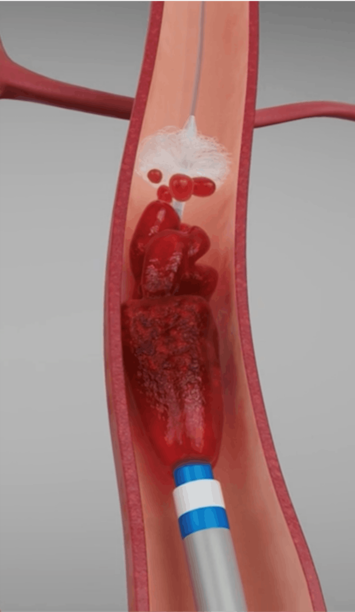 thrombectomy surgery