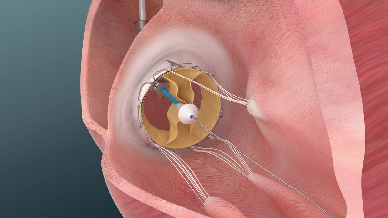 Tricuspid Valve Replacement System Shows Promise for Treating Heart ...