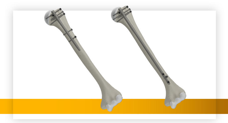 Stryker Launches Alpha Humerus Nailing System | Medical Design ...